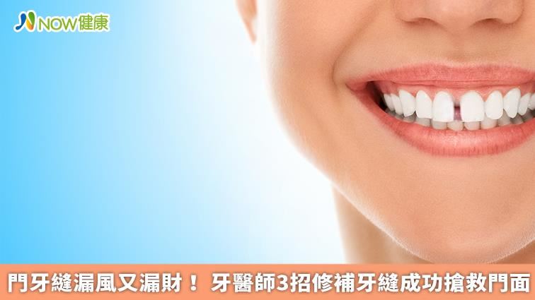 NOW健康／門牙縫漏風又漏財！ 牙醫師3招修補牙縫成功搶救門面 | 名家 | 三立新聞網 SETN.COM