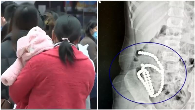 腹痛1個月！4歲女童照X光驚見「61顆白點點」醫嘆一輩子毀了 | 兩岸(大陸) | 三立新聞網 SETN.COM