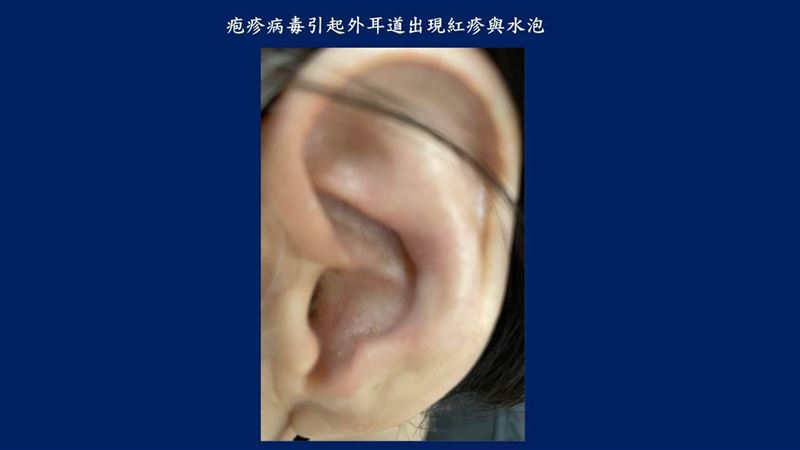 單側嘴歪以為中風！65歲男「耳後長水泡」才揪出染「皮蛇」 | 生活 | 三立新聞網 SETN.COM