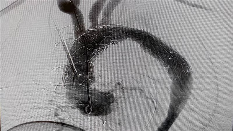 未爆彈！6.5cm「主動脈瘤」隨時索命 醫療團隊靠1招拆彈 | 健康 | 三立新聞網 SETN.COM