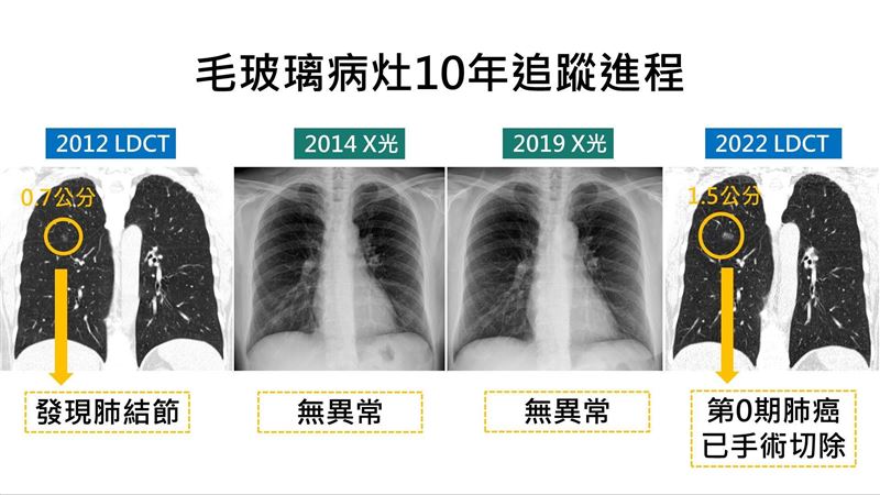 腫瘤會玩「捉迷藏」…他照2次X光無異狀 LDCT一掃：肺癌！ | 健康 | 三立新聞網 SETN.COM