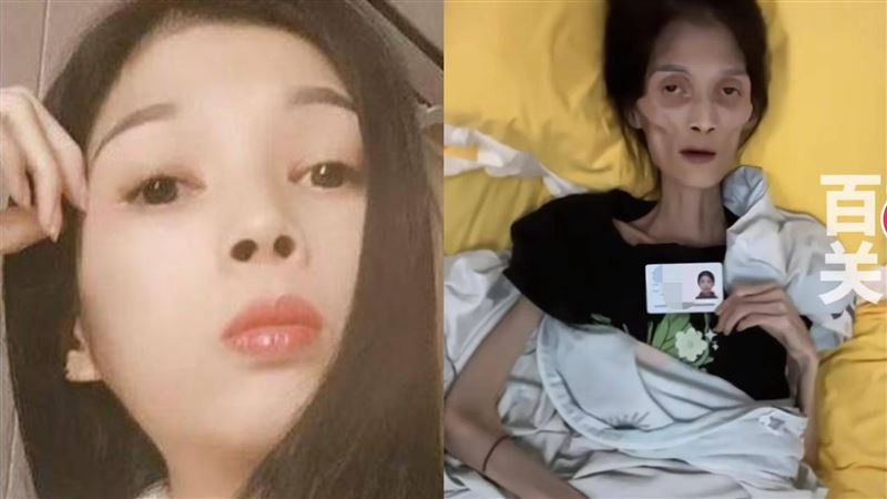 27歲正妹罹患胃萎縮！「45公斤暴瘦剩17kg」形如骷髏 悲慘身世曝 | 兩岸(大陸) | 三立新聞網 SETN.COM
