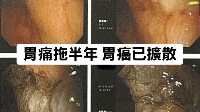 35歲女胃痛拖半年！醫一看「癌細胞擴散整個腹腔」 嘆：已無法開刀 | 生活 | 三立新聞網 SETN.COM